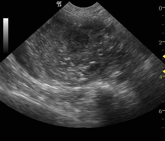 Pancreatic abscess and suppurative pyogranulomatous inflammation in a 4 ...