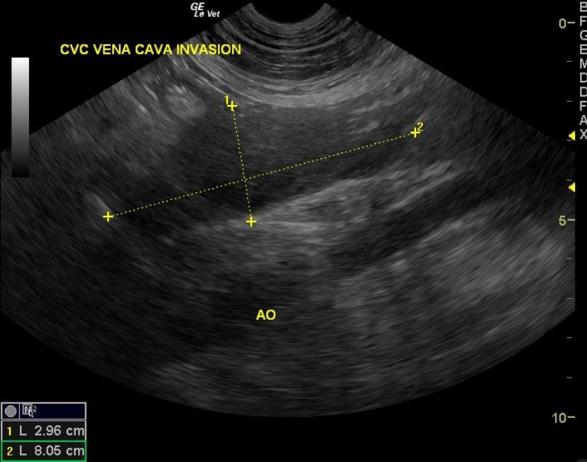 Left adrenal mass with CVC invasion and a concurrent gastric foreign ...