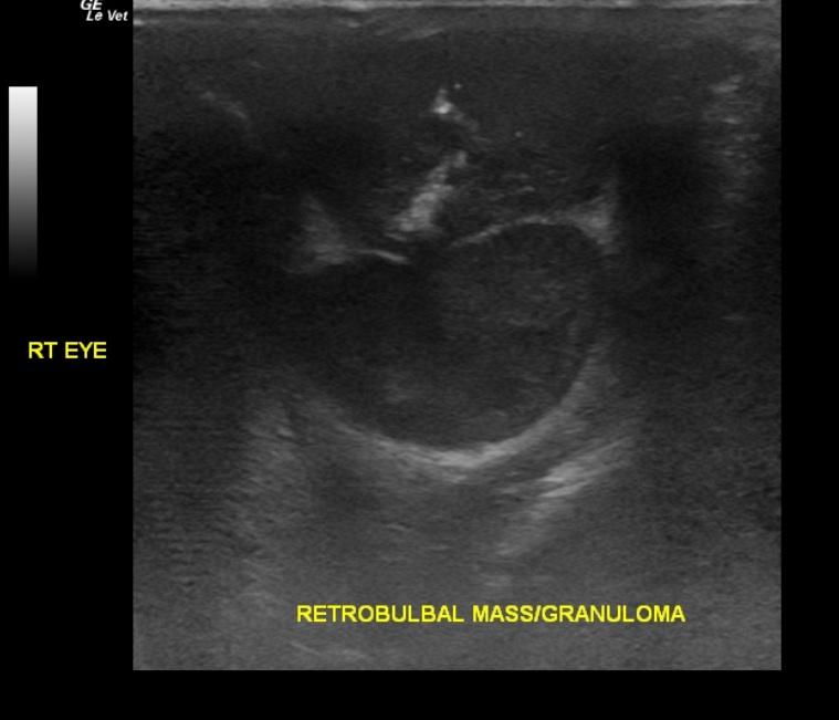 Retrobulbar carcinoma or adenocarcinoma diagnosed by FNA in a 12 year ...