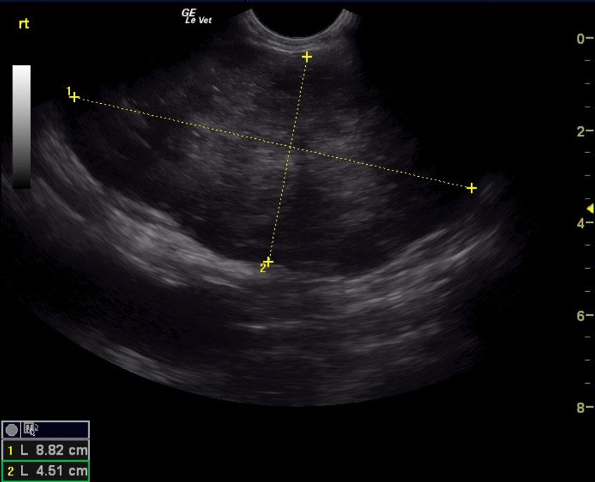 Bilateral thyroid masses with probable liver metastasis in a 14 year ...