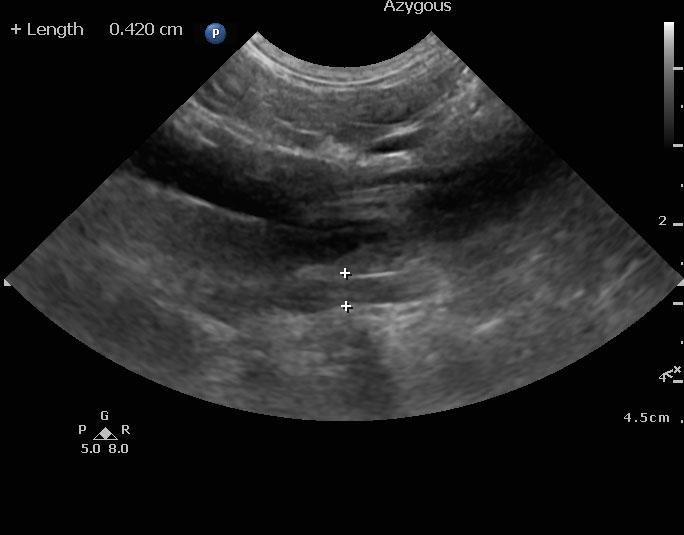 Splenoazygous shunt in an 8 year old FS Maltese - Members