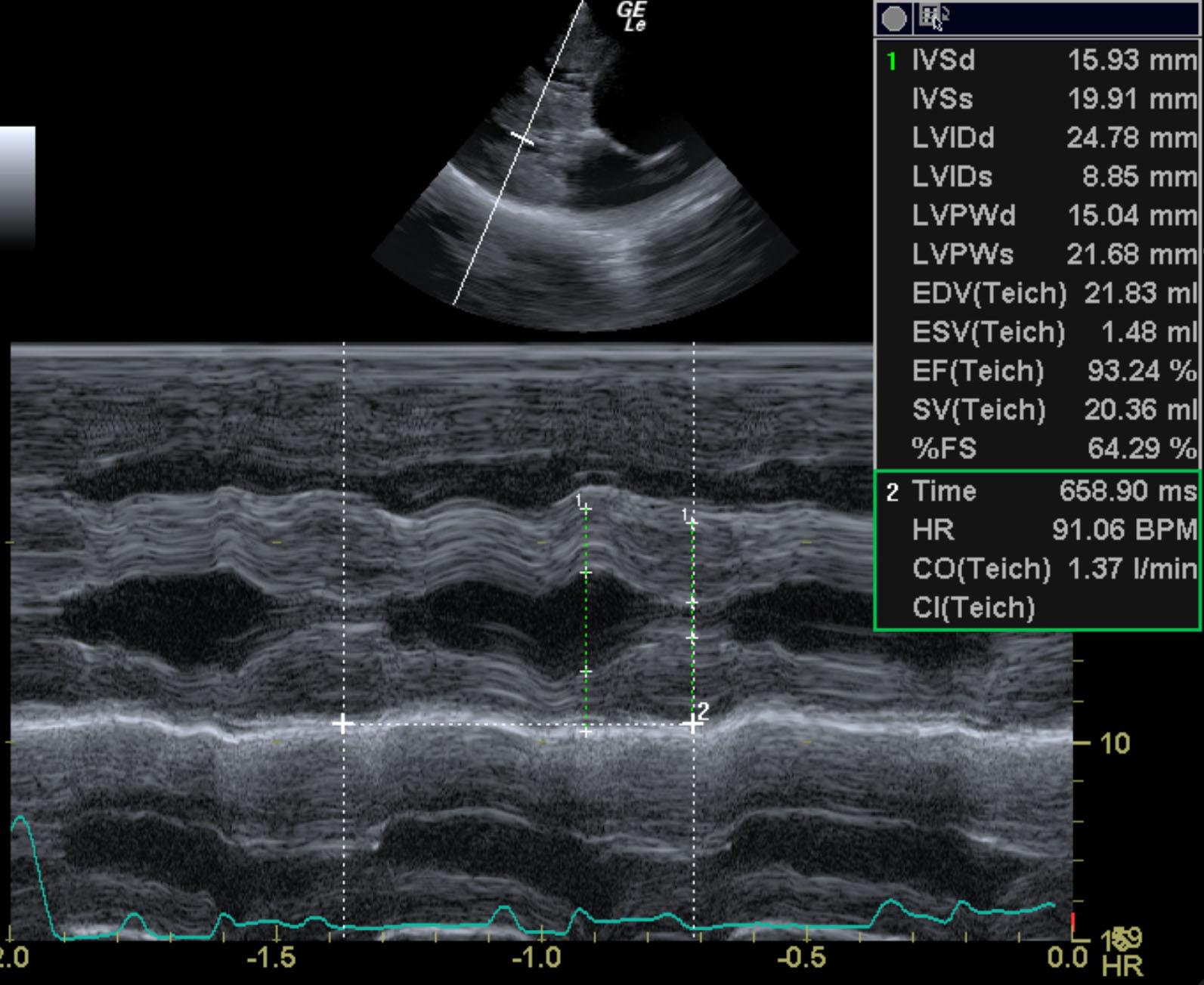 Subaortic stenosis (SAS) and pulmonic stenosis in a 11 year old MN ...
