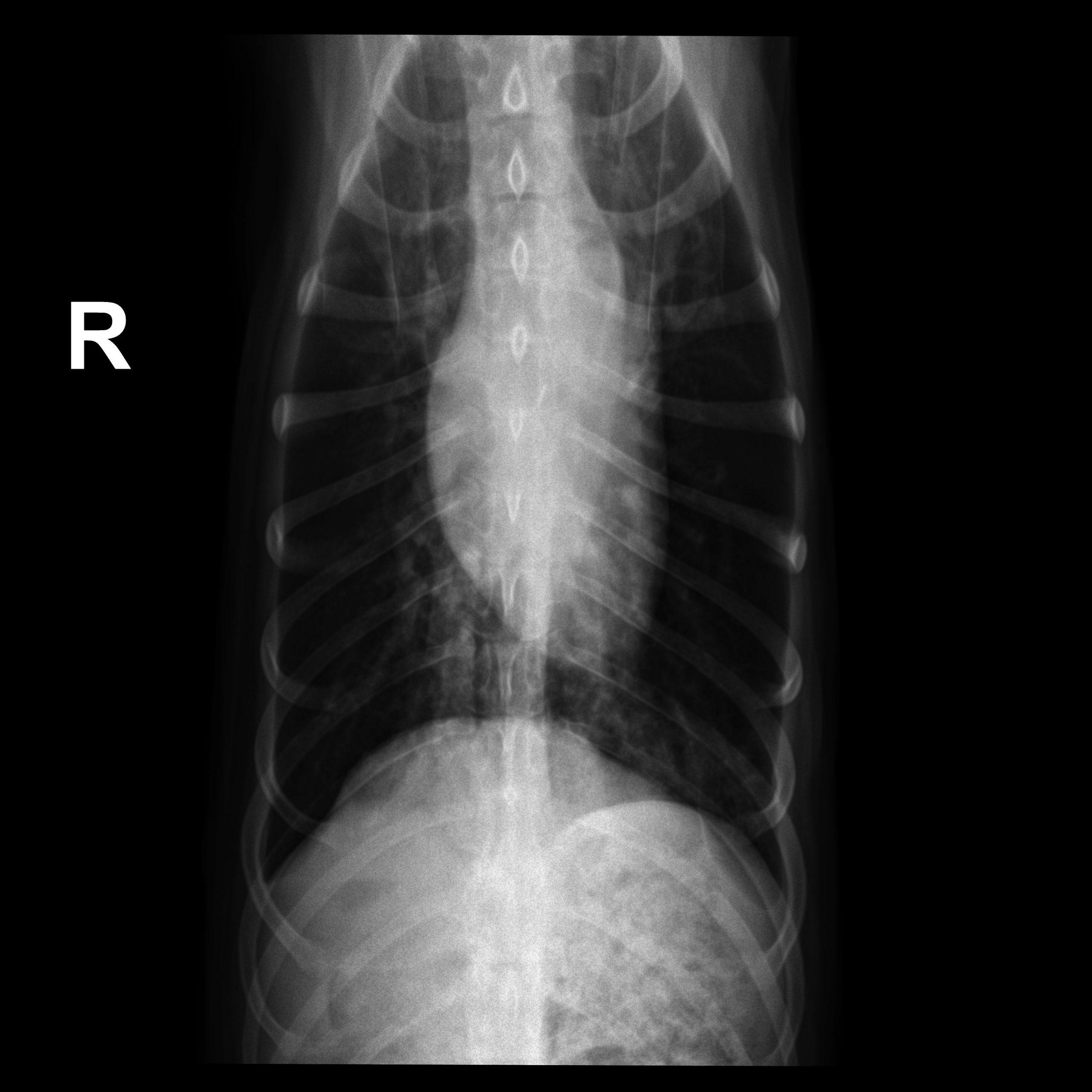RADS - Non-Cardiogenic Pulmonary Edema, Chronic Bronchial Pattern and ...