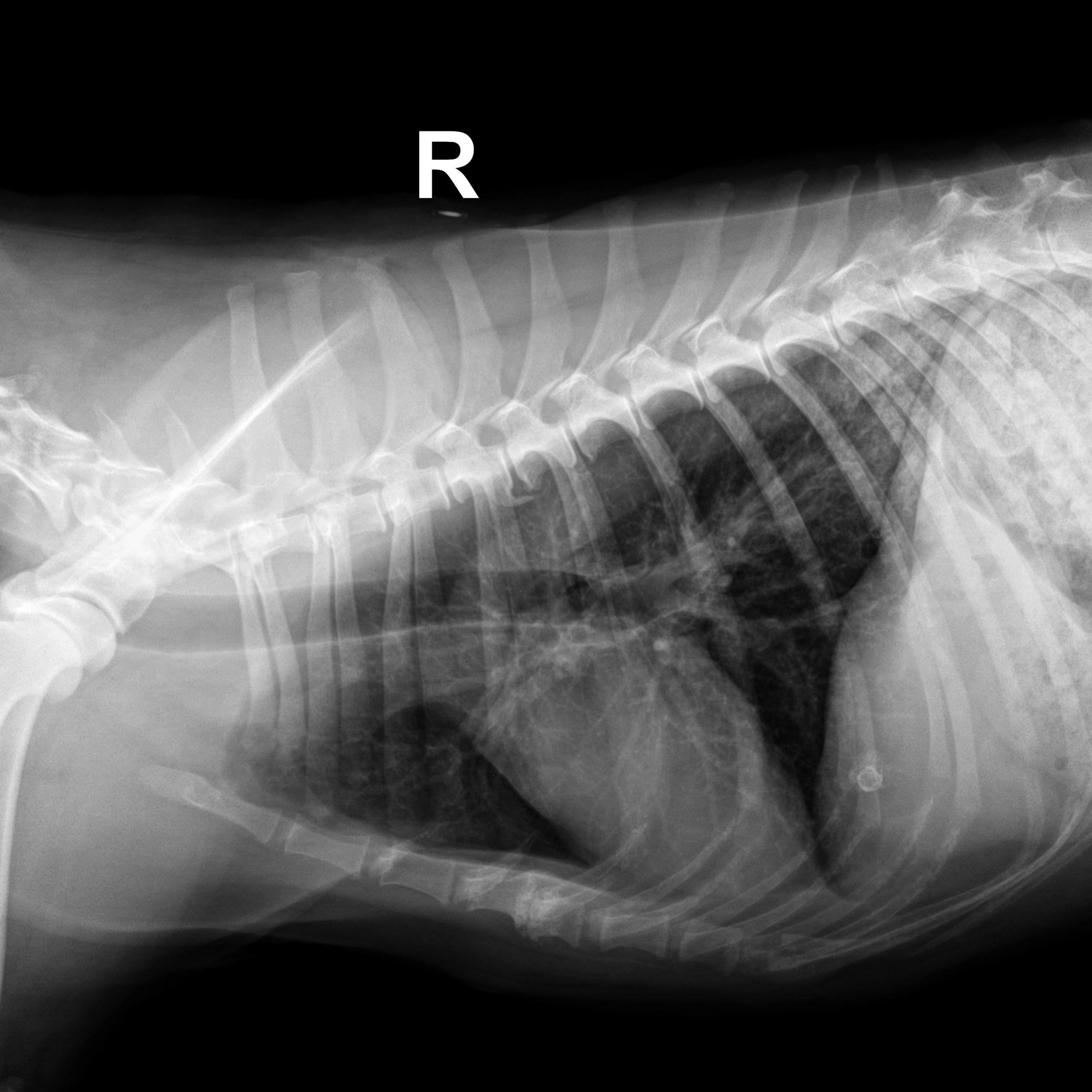 RADS - Non-Cardiogenic Pulmonary Edema, Chronic Bronchial Pattern and ...