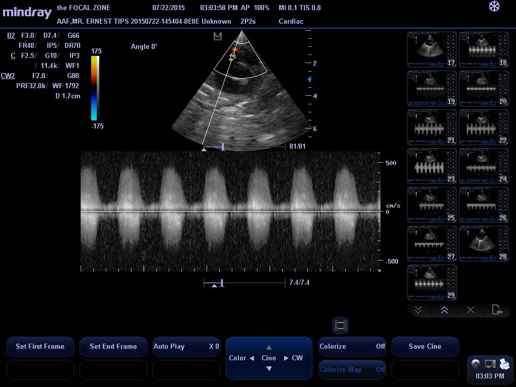 Ventricular Septal Defect Restrictive In A 4 Month Old Male Dsh Cat