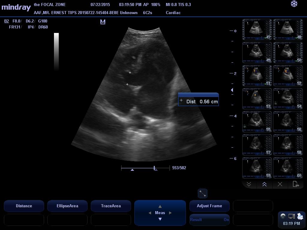 Ventricular Septal Defect, Restrictive, in a 4 month old male DSH cat ...