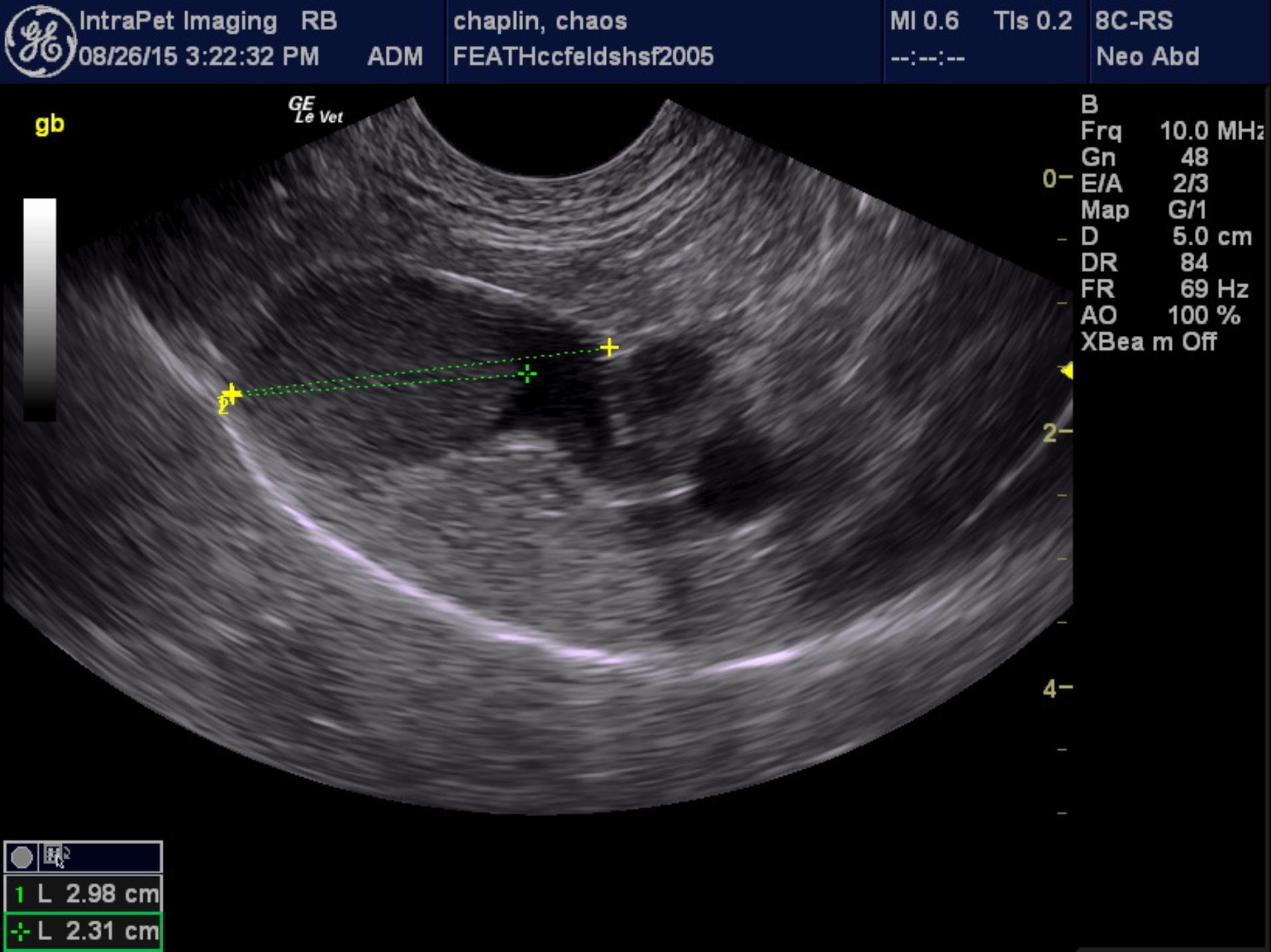 Post Hepatic Obstruction with Strictured Duodenal Papilla and Congested ...