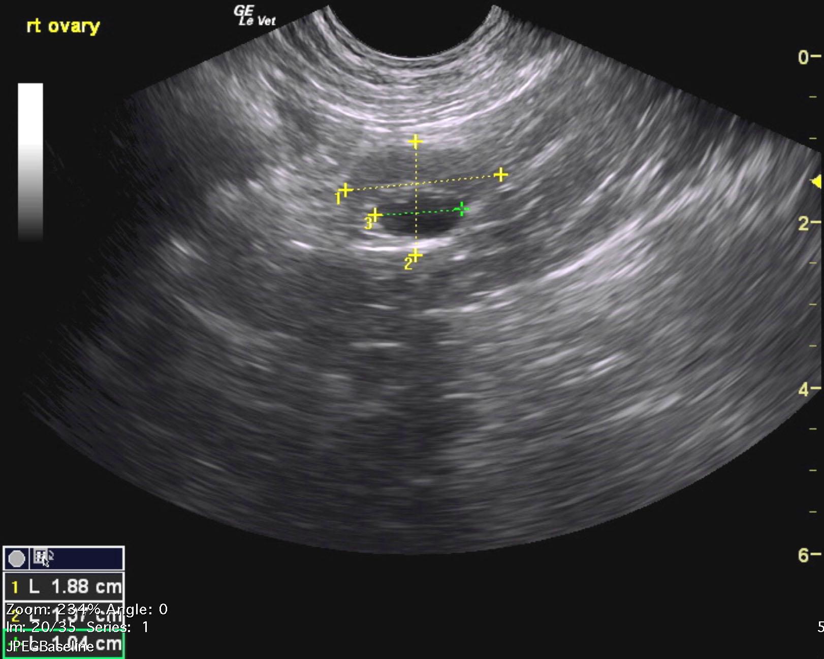 09_00159 Artemis G Ovarian remnant, stump hypertrophy - Members