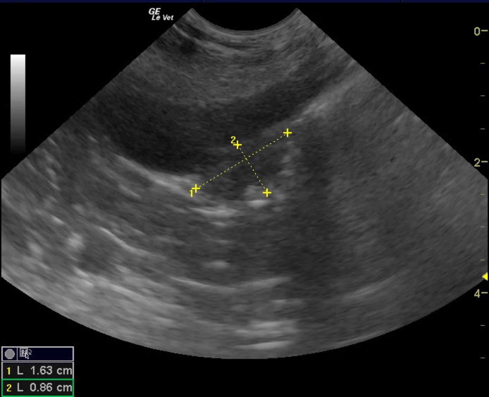 09_00157 Duff H Ovarian remnant, uterine stump hypertrophy - Members