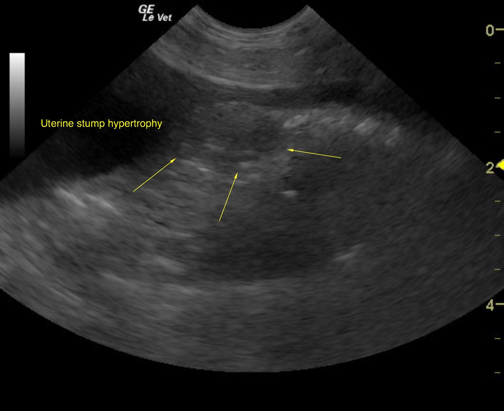 09_00157 Duff H Ovarian remnant, uterine stump hypertrophy - Members