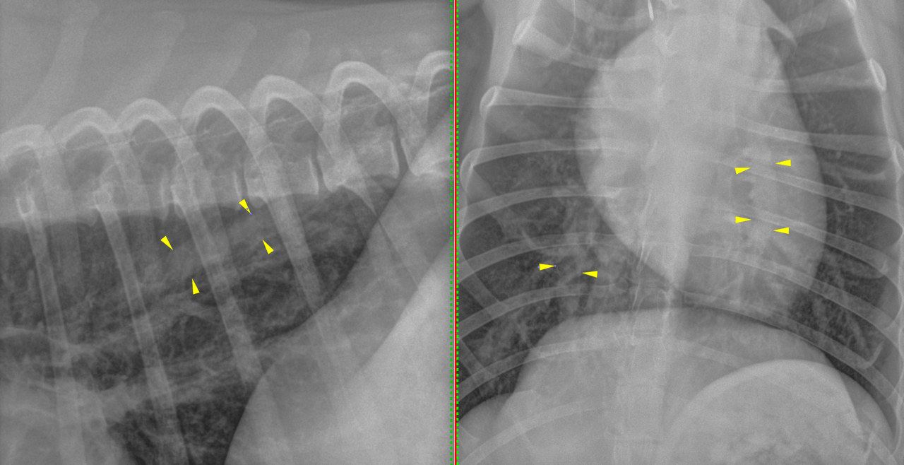 RAD - Bronchointerstitial lung pattern with pulmonary arterial ...