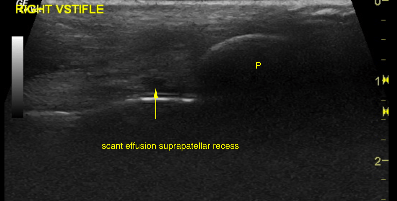 ORTHO - Rupture of the left cranial cruciate ligament (CCL) with ...