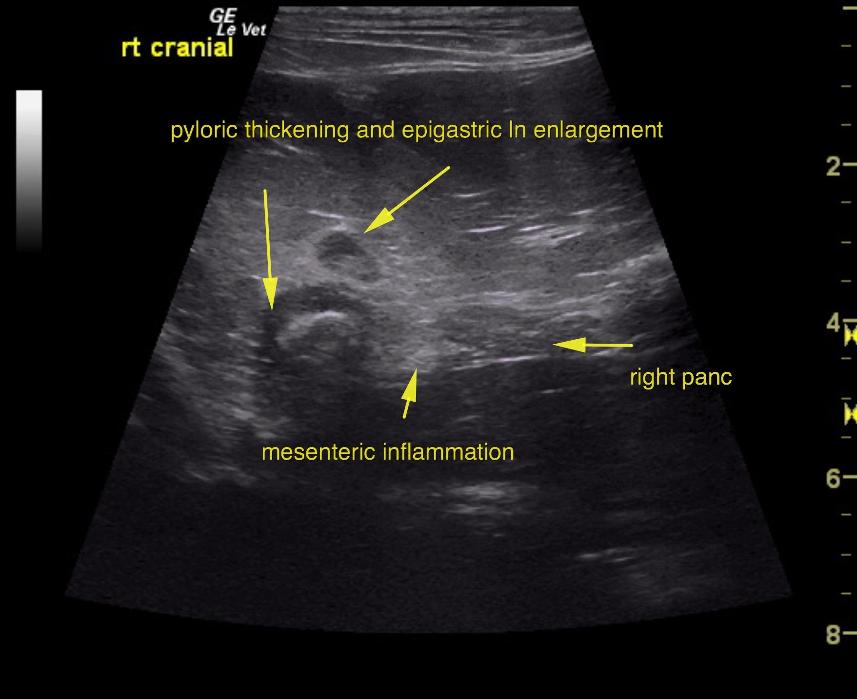 04_00517 Ziggy B Pyloric thickening, epigastric lymphadenopathy - Members