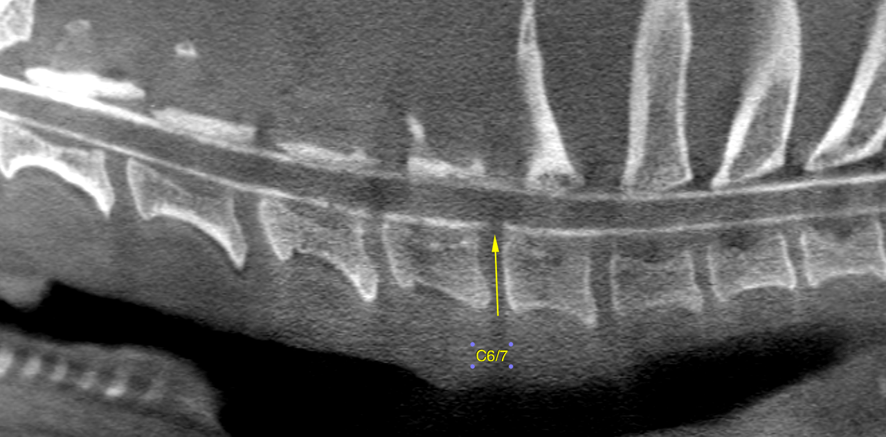 CT - Mild intervertebral disc protrusion and congenital scoliotic ...