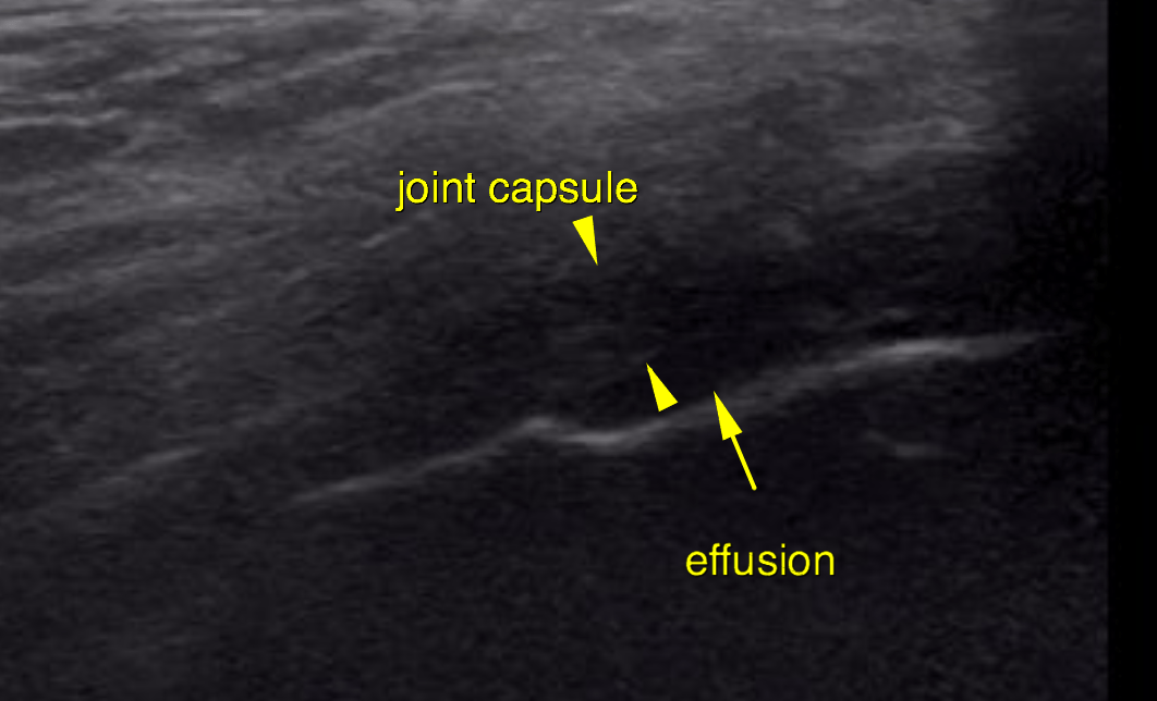 ORTHO - Degenerative joint disease (DJD) with partial cranial cruciate ...
