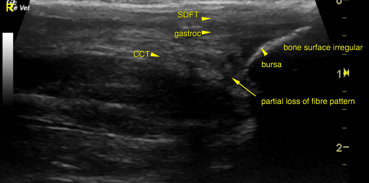ORTHO - Partial avulsion rupture of the calcaneal tendon with ...