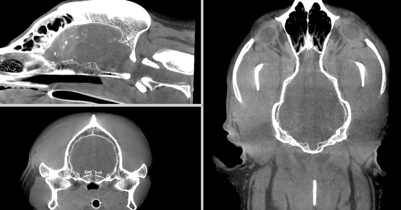 CT - Mild generalized periodontal disease with emerging jaw bone ...