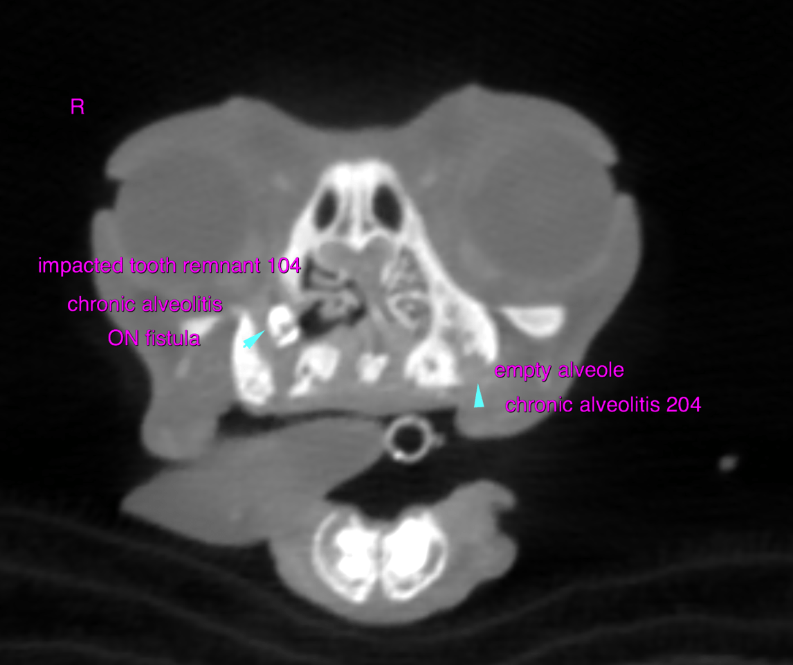 CT - Chronic alveolis oronasal fistula with destructive rhinitis ...