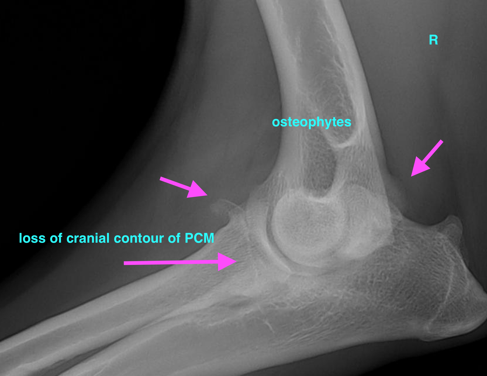 RAD - Bilateral elbow dysplasia with coronoid pathology and possible ...