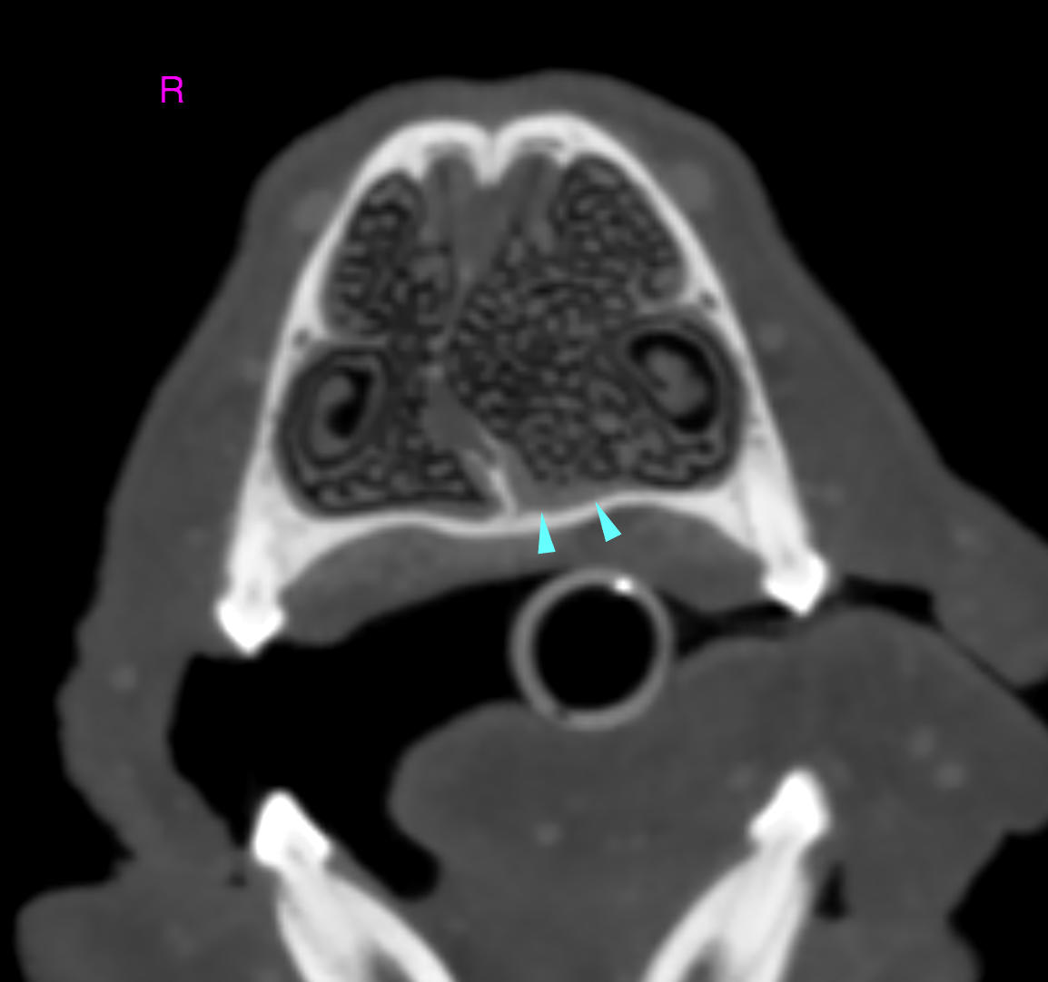 CT - Unspecific non-destructive rhinitis of the left nasal cavity in a ...